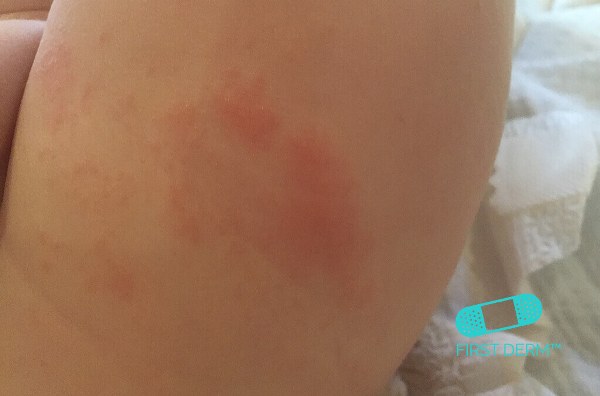 How to deal with Skin Rashes in Babies and Toddlers