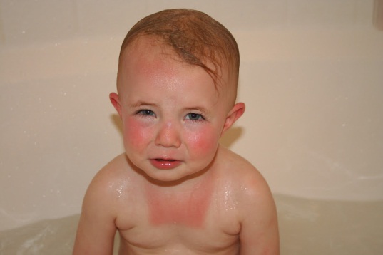 How to deal with Skin Rashes in Babies and Toddlers